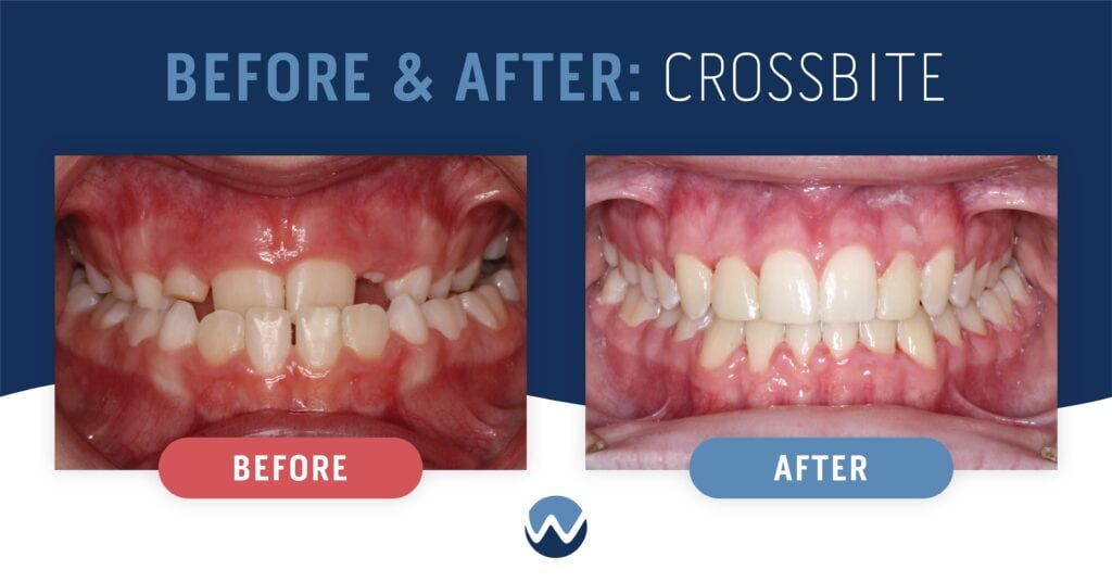 What's a Crossbite? 3 Case Studies Show How We Can Help • Woodhill ...