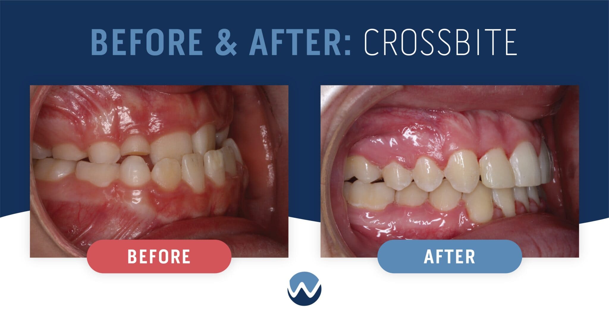 What's a Crossbite? 3 Case Studies Show How We Can Help • Woodhill ...