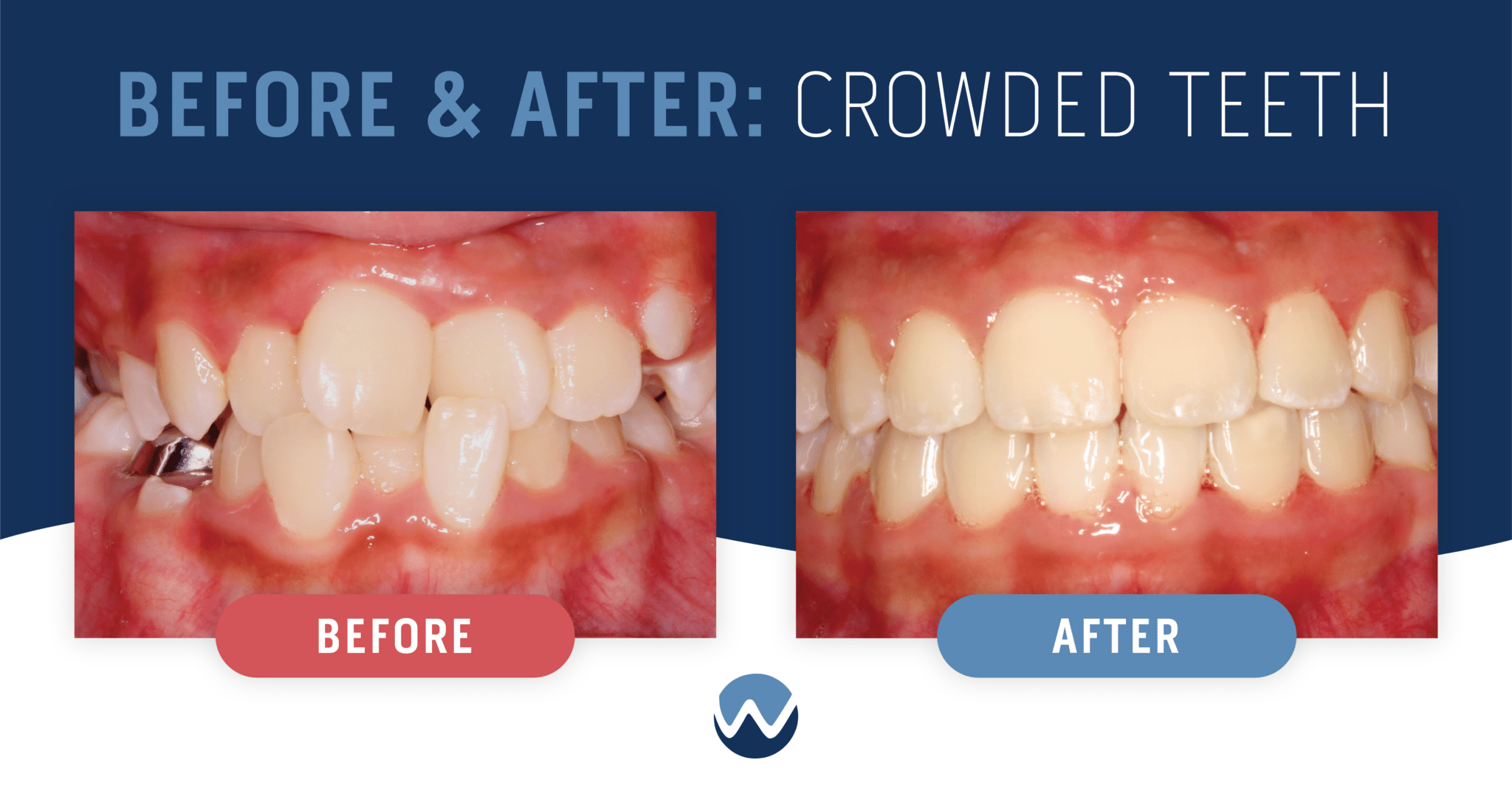 Ways We Can Help With Teeth Crowding • Woodhill Dental Specialties ...
