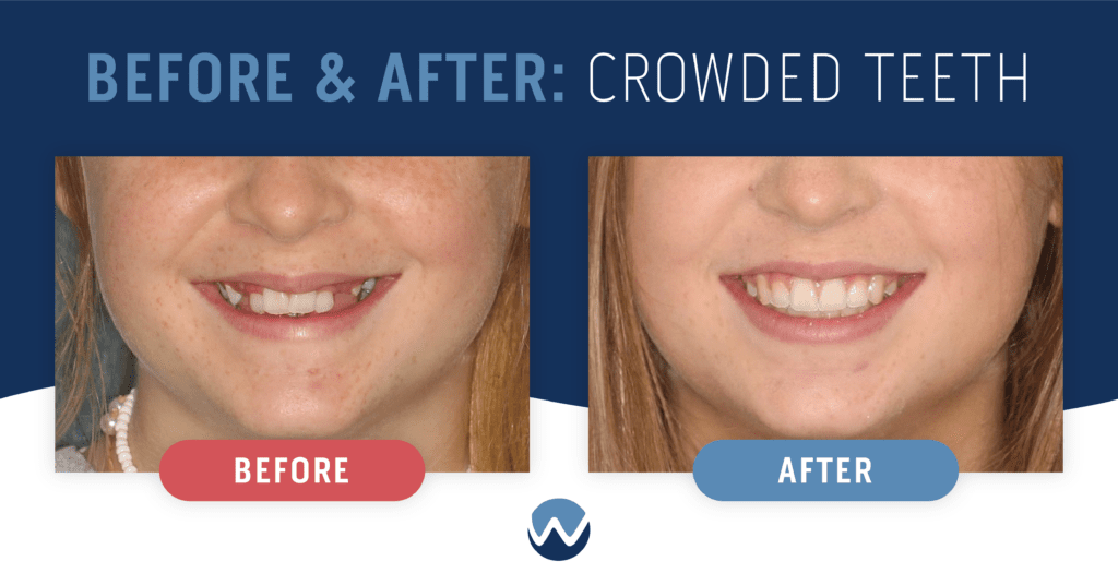 Ways We Can Help With Teeth Crowding • Woodhill Dental Specialties ...