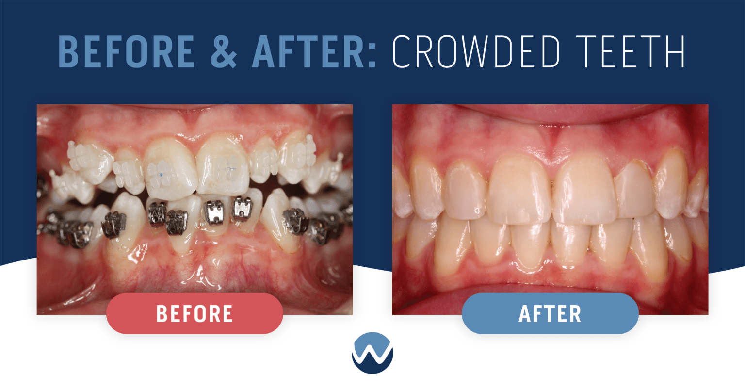 Ways We Can Help With Teeth Crowding • Woodhill Dental Specialties ...