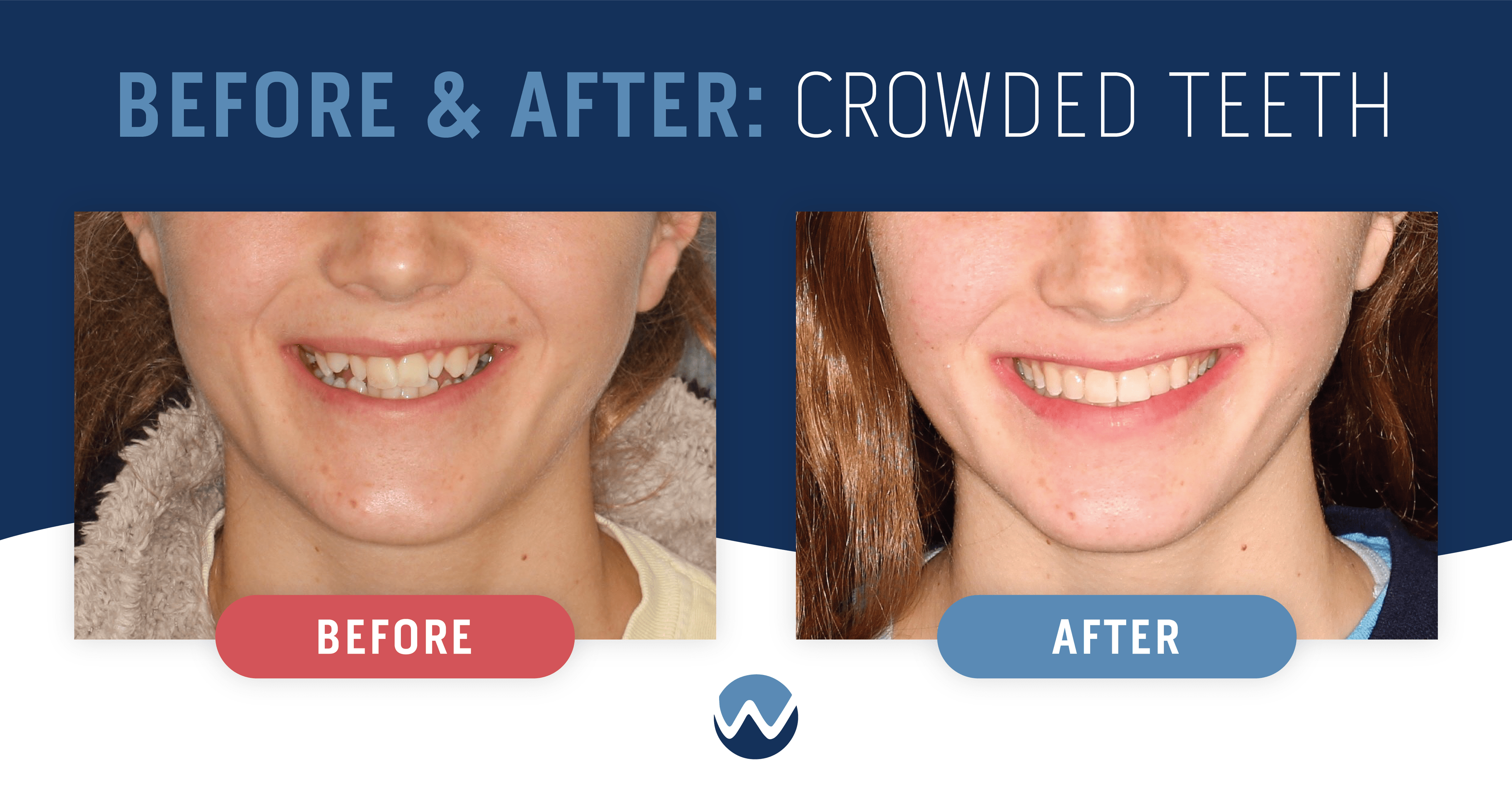 Ways We Can Help With Teeth Crowding • Woodhill Dental Specialties ...