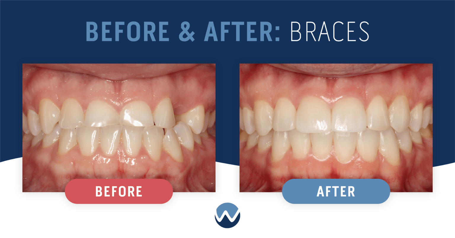 Before & After Braces: See the Amazing Results Yourself! • Woodhill ...