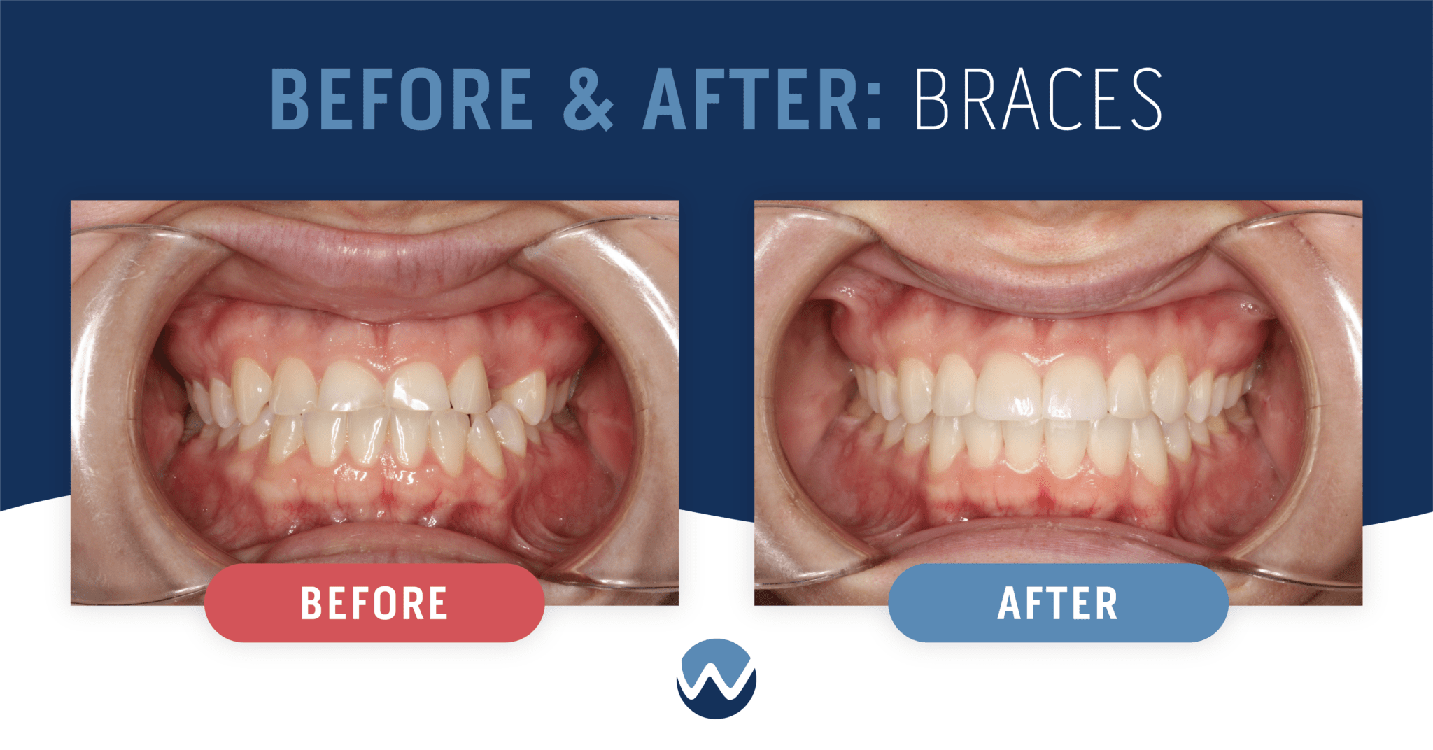 Before & After Braces: See the Amazing Results Yourself! • Woodhill ...