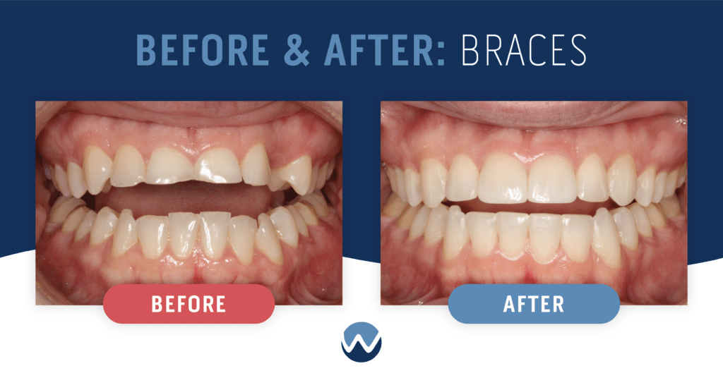 Before & After Braces: See the Amazing Results Yourself! • Woodhill ...