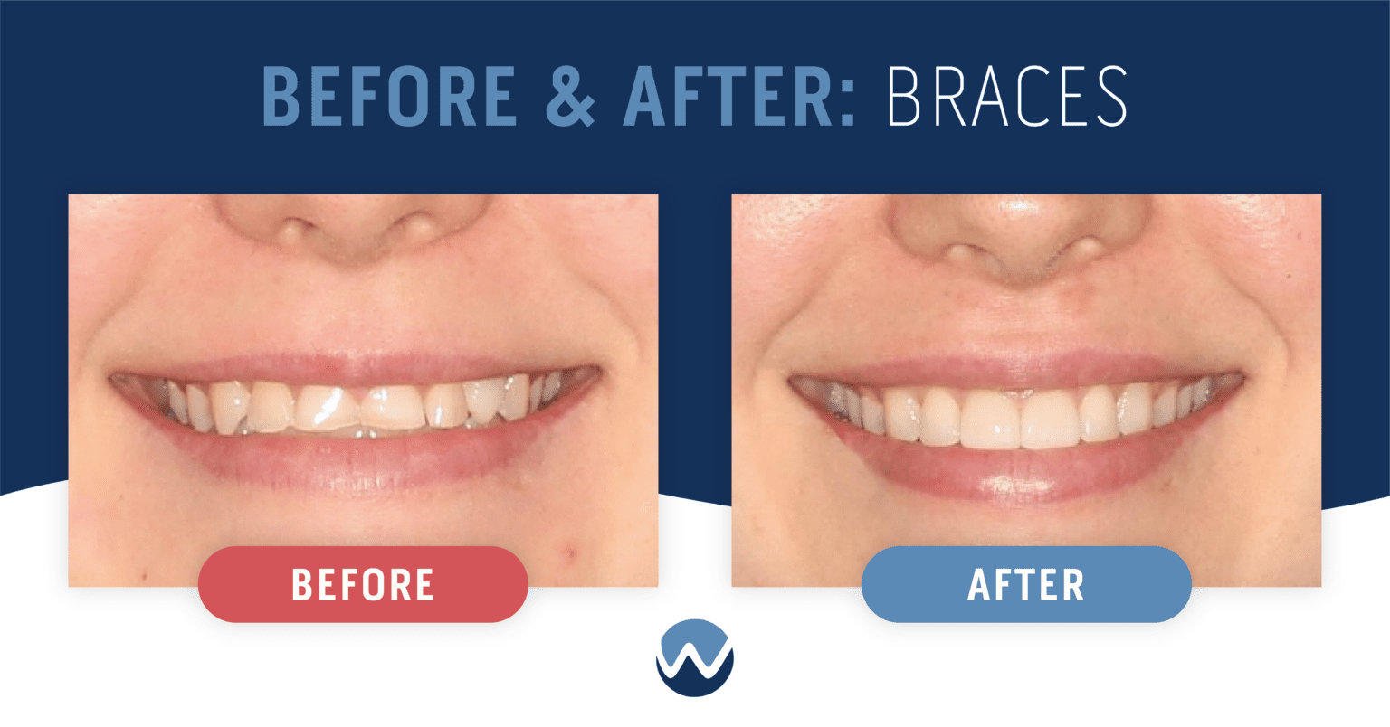 Before & After Braces: See the Amazing Results Yourself! • Woodhill ...