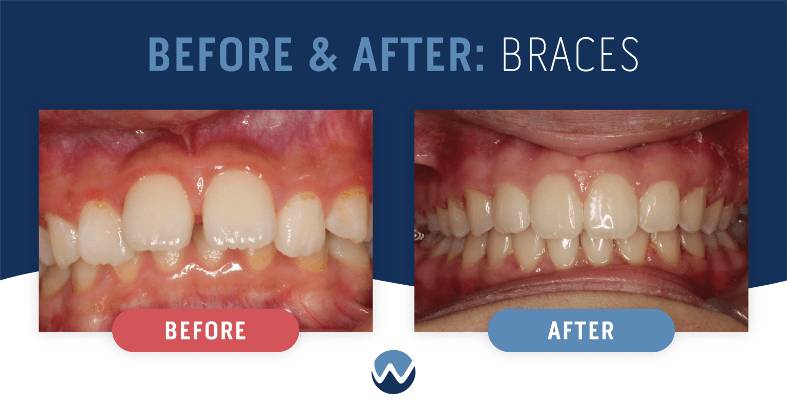 Before & After Braces: See the Amazing Results Yourself! • Woodhill ...