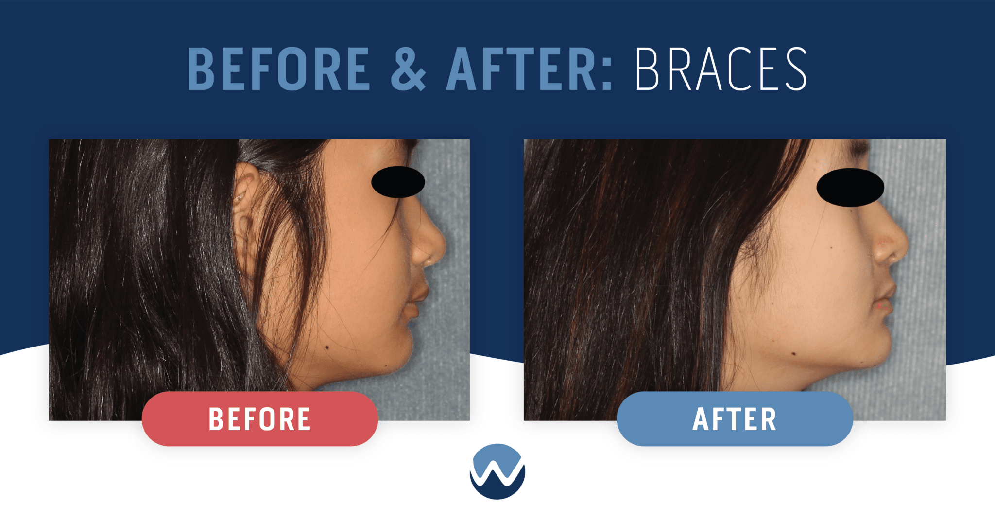 Before & After Braces: See the Amazing Results Yourself! • Woodhill Dental Specialties ...