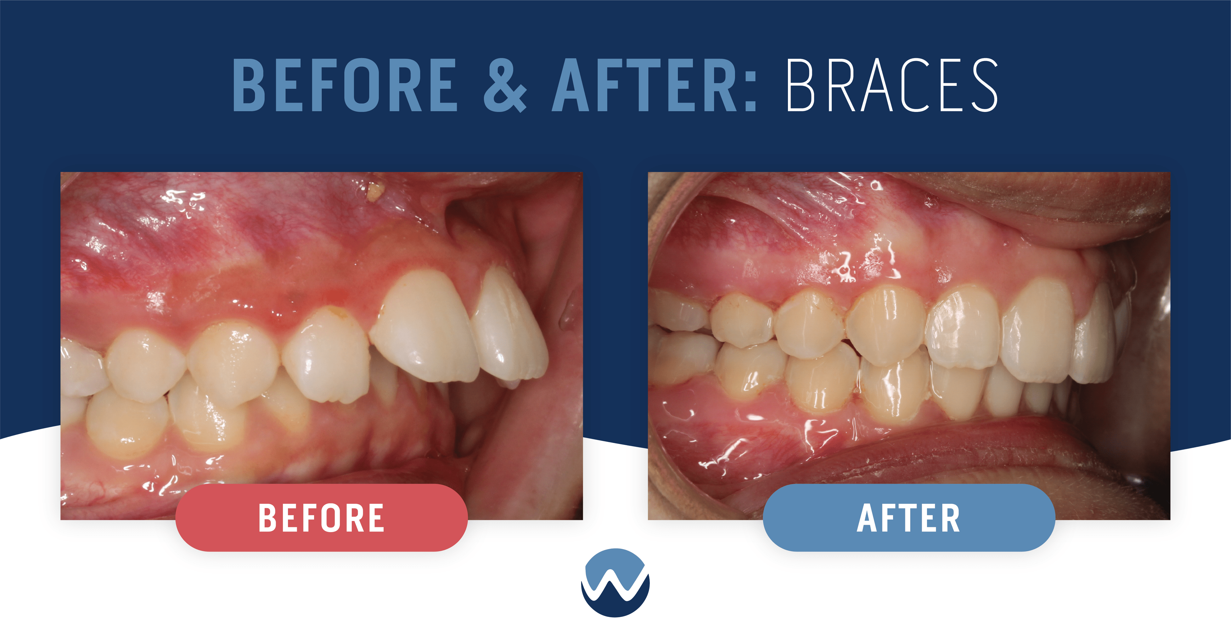 Before & After Braces: See the Amazing Results Yourself! • Woodhill ...