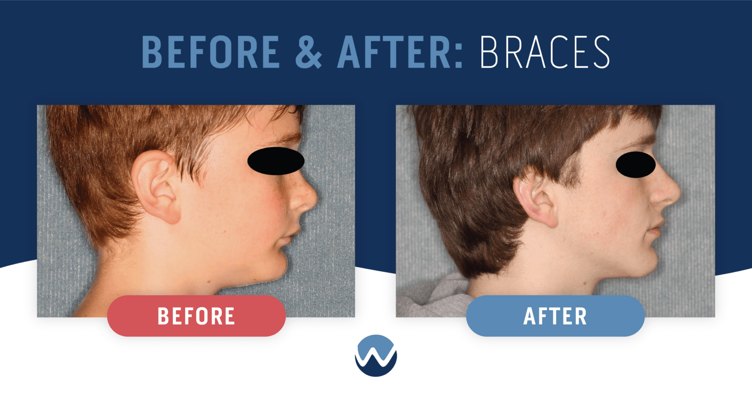 Before & After Braces: See the Amazing Results Yourself! • Woodhill ...