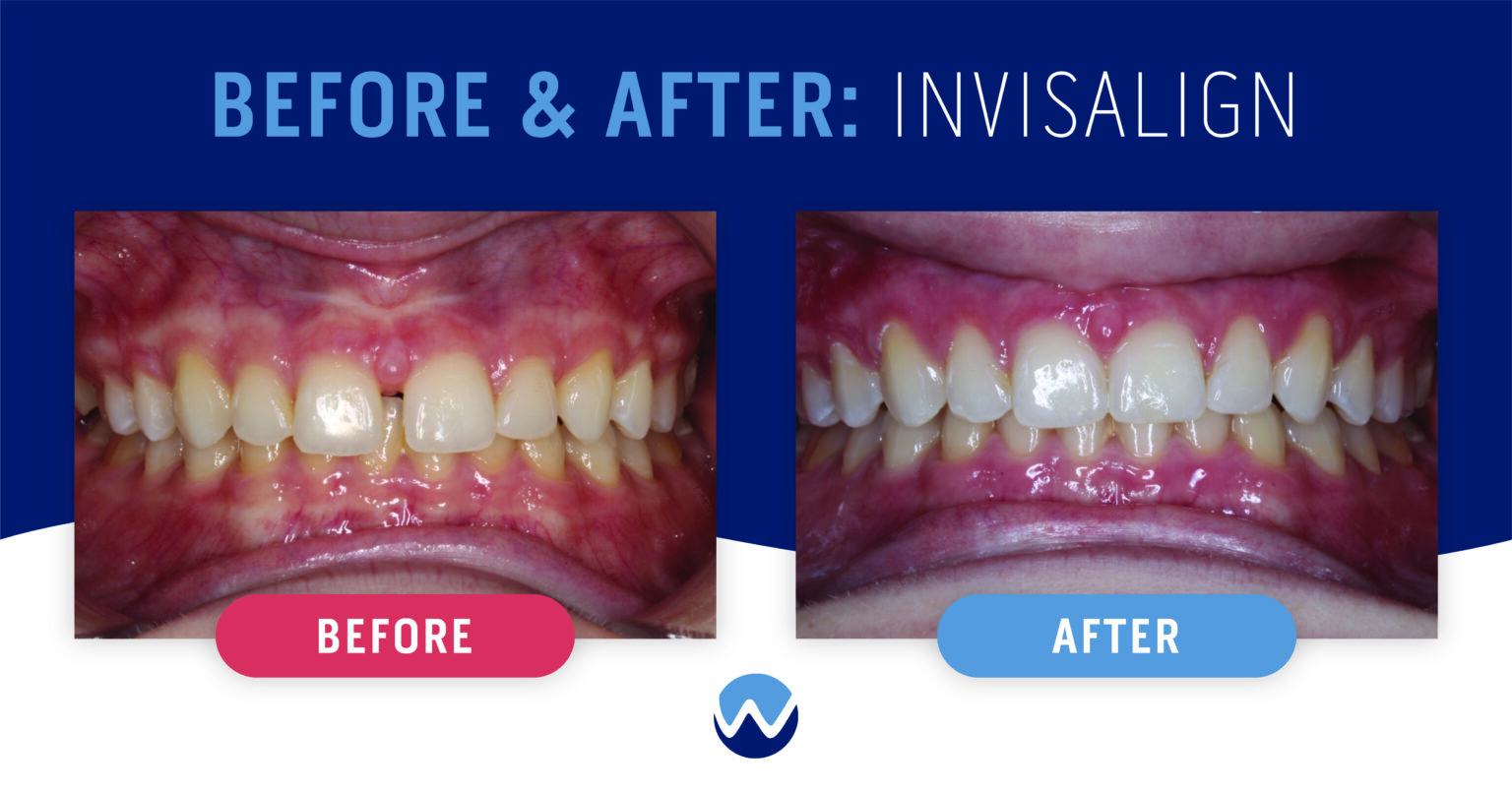 Clear Aligners Before & After: See How They Transform Smiles • Woodhill ...