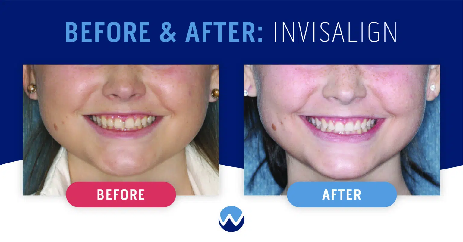 Clear Aligners Before & After: See How They Transform Smiles • Woodhill ...