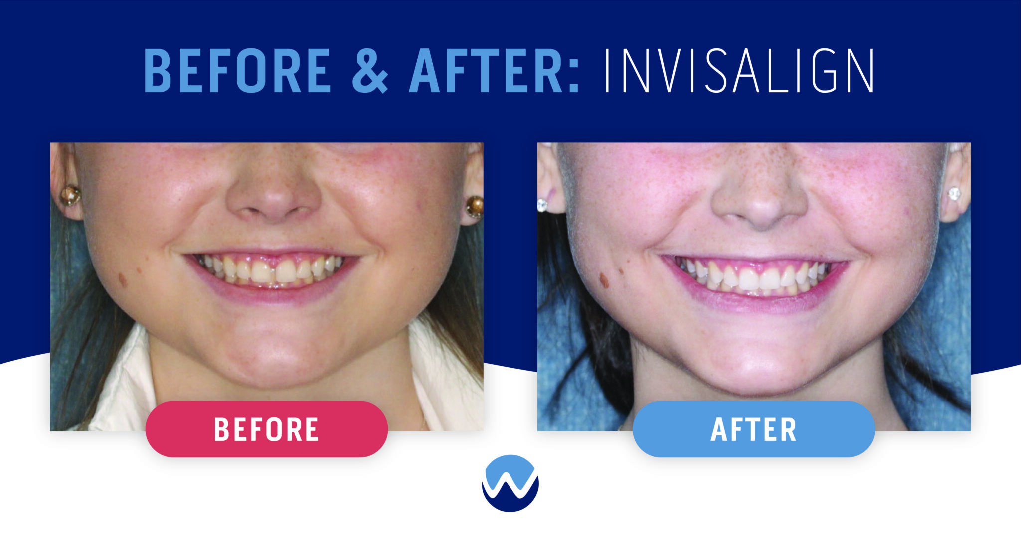 Clear Aligners Before & After: See How They Transform Smiles • Woodhill ...
