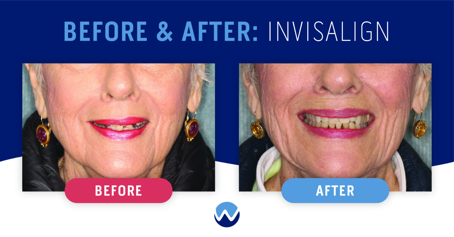 Clear Aligners Before & After: See How They Transform Smiles • Woodhill ...